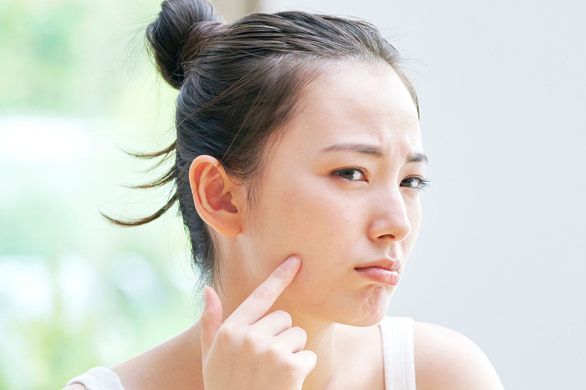 How To Get Rid of Cheek Acne [10 Causes and Treatments] | bioClarity