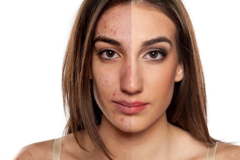 How To Get Rid of Acne Scars: 11 Top Treatments | bioClarity