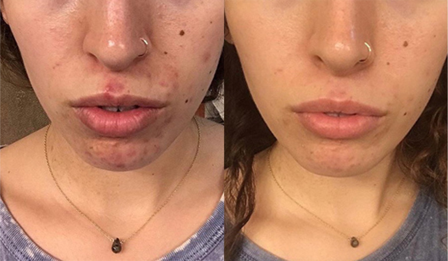 Clear Skin Routine - Plant-Based Acne Treatment Set – bioClarity